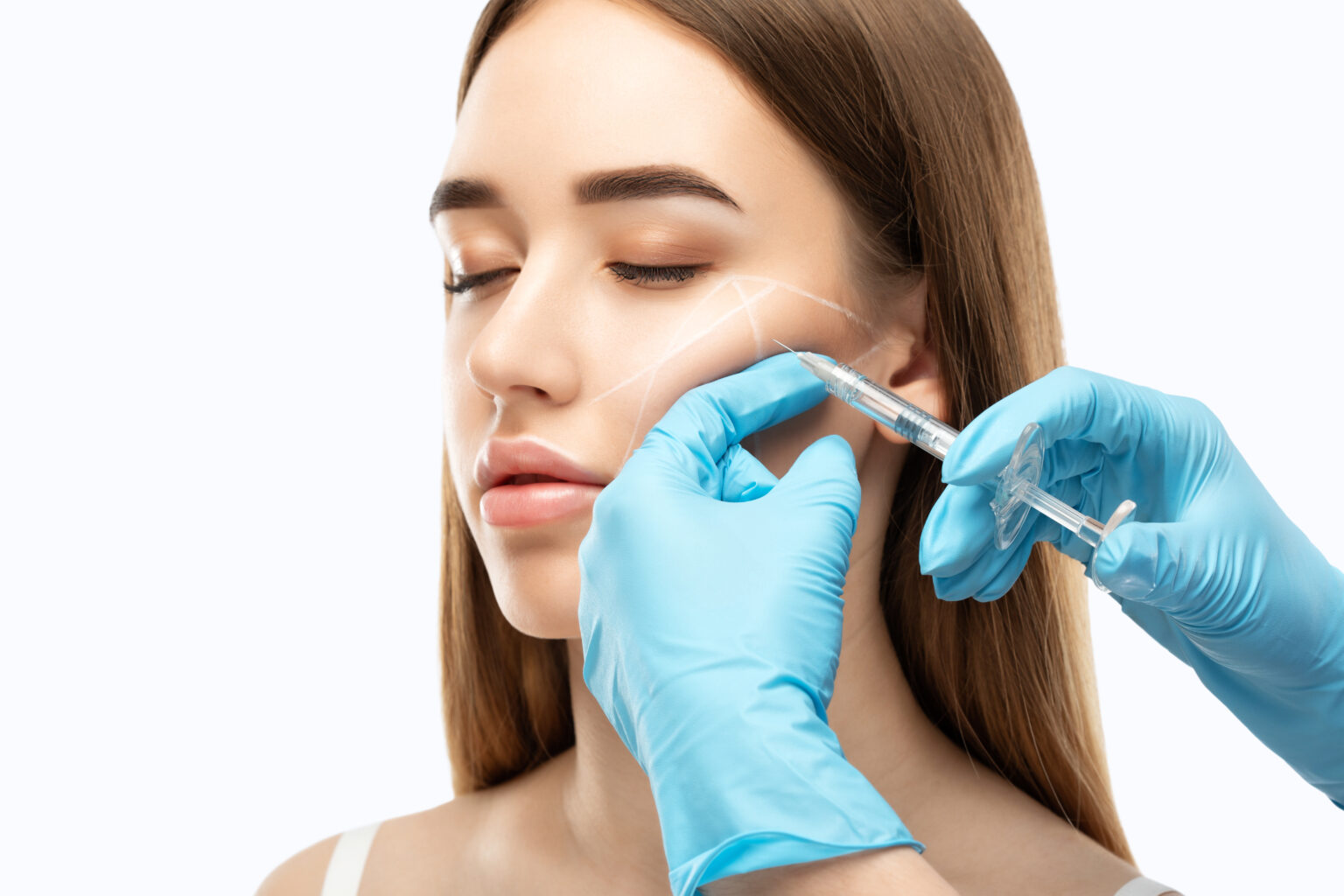 Can Dermal Fillers Help with Acne Scars? The Sculptry